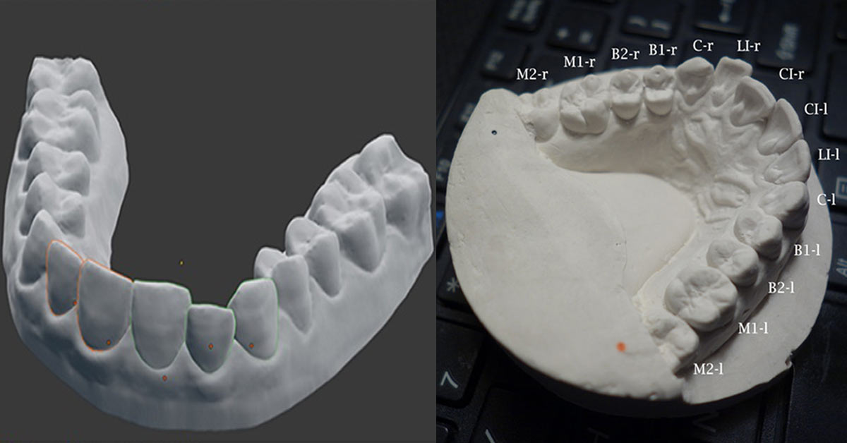 College Student 3D Prints Cheap DIY Retainers to Fix His Crooked Teeth