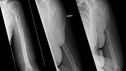 Researchers Finally Solved the Mystery Behind Rare Bone Disease