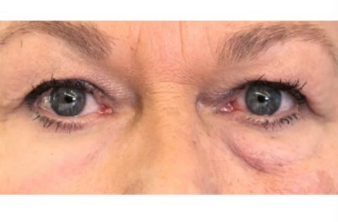 Transparent 'Second Skin' Erases Wounds And Wrinkles