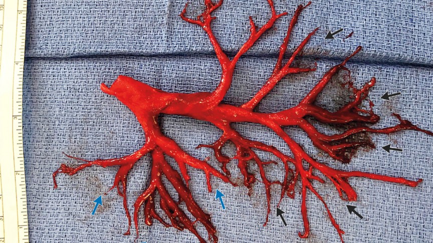 Patient Coughs A Blood Clot Looking Like A Lung Passage