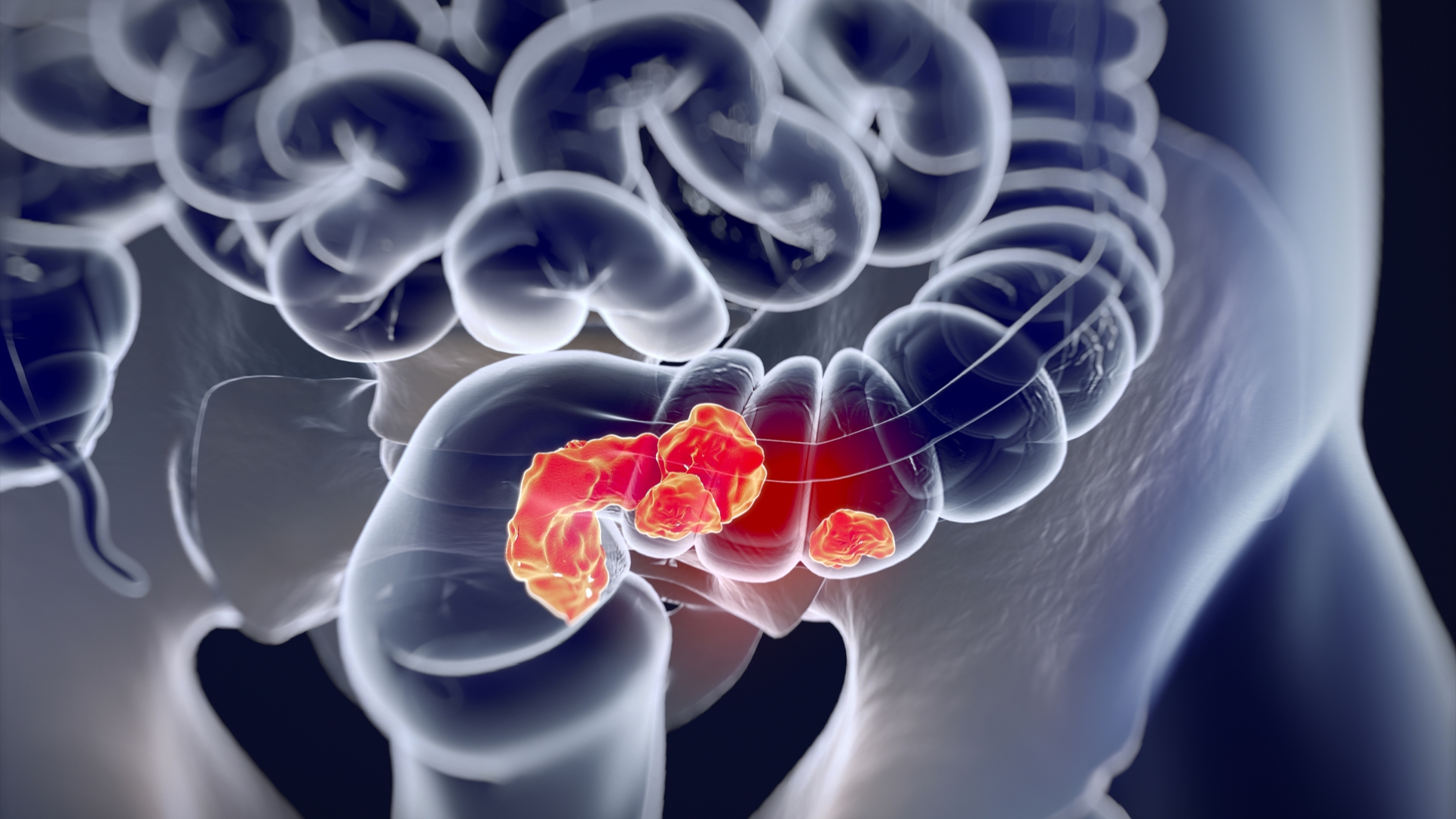 A breakthrough drug trial astonished doctors by curing rectal cancer in ...