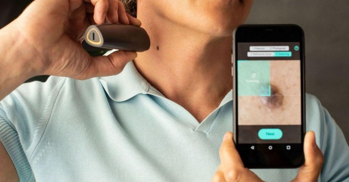 Introducing NOTA: A Revolutionary Skin Mole Monitoring Device